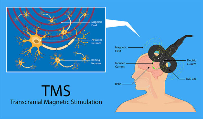 TMS for Depression | Holistic Rehab | Iris Healing® Retreat